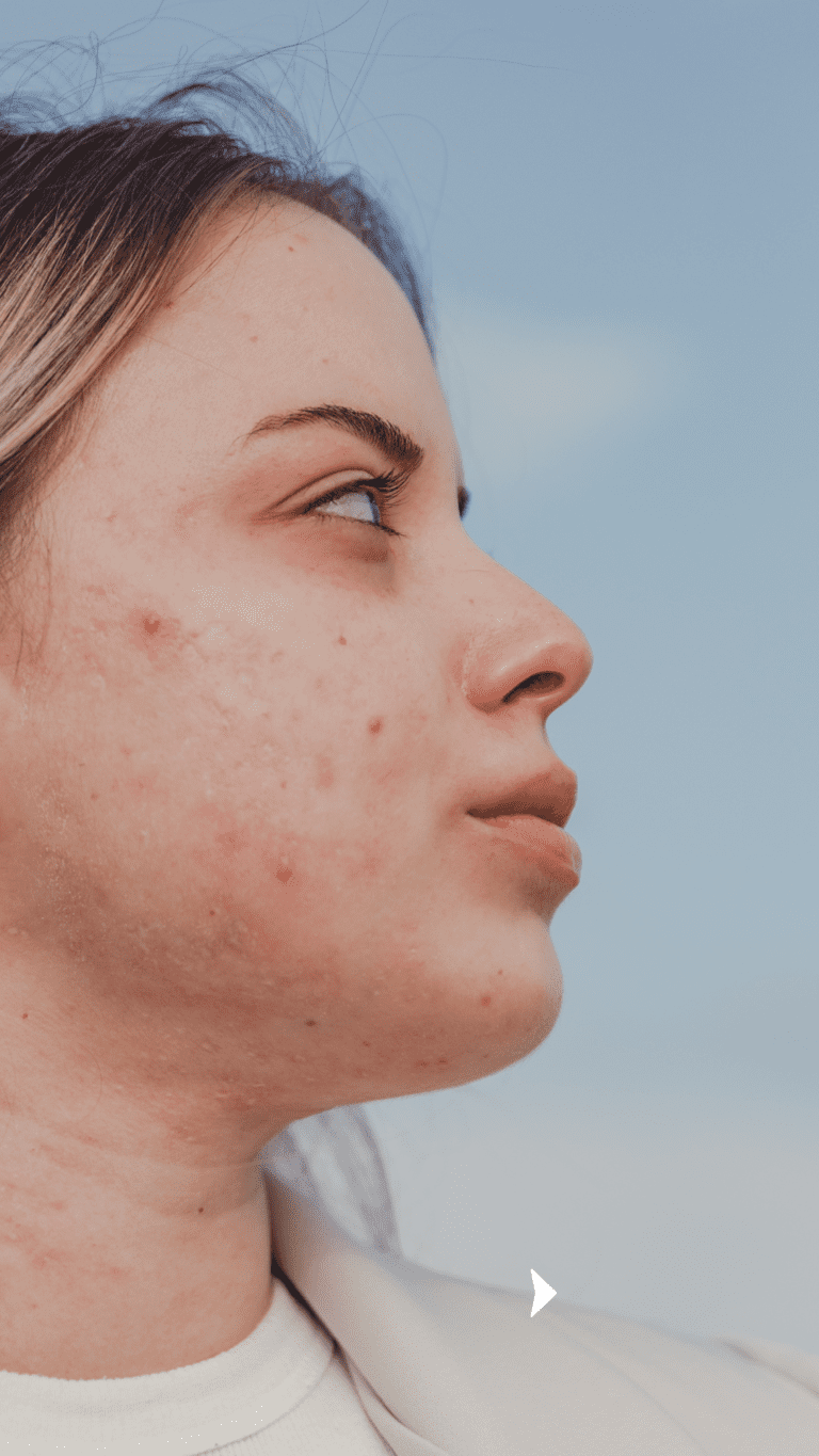 Acne Facial - Saint Aesthetix | Med Spa in Monrovia