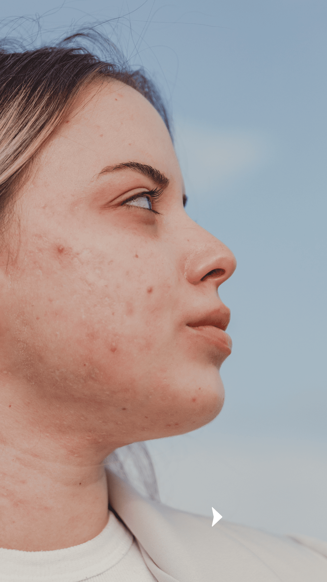Acne Facial - Saint Aesthetix | Med Spa in Monrovia
